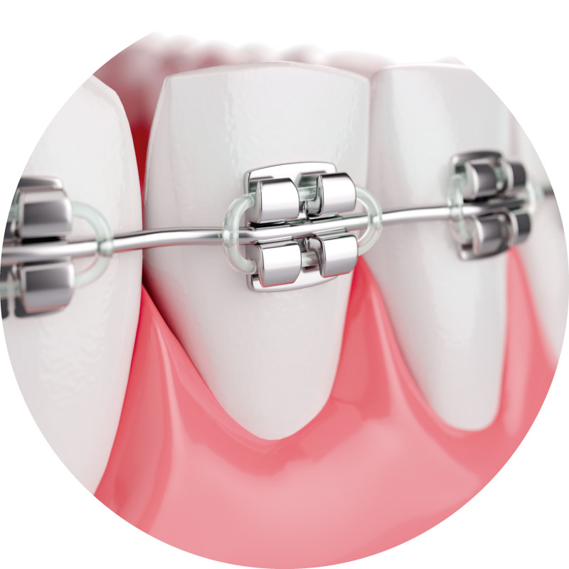 Ortodoncia en Barcelona | Dental Spa Clinics